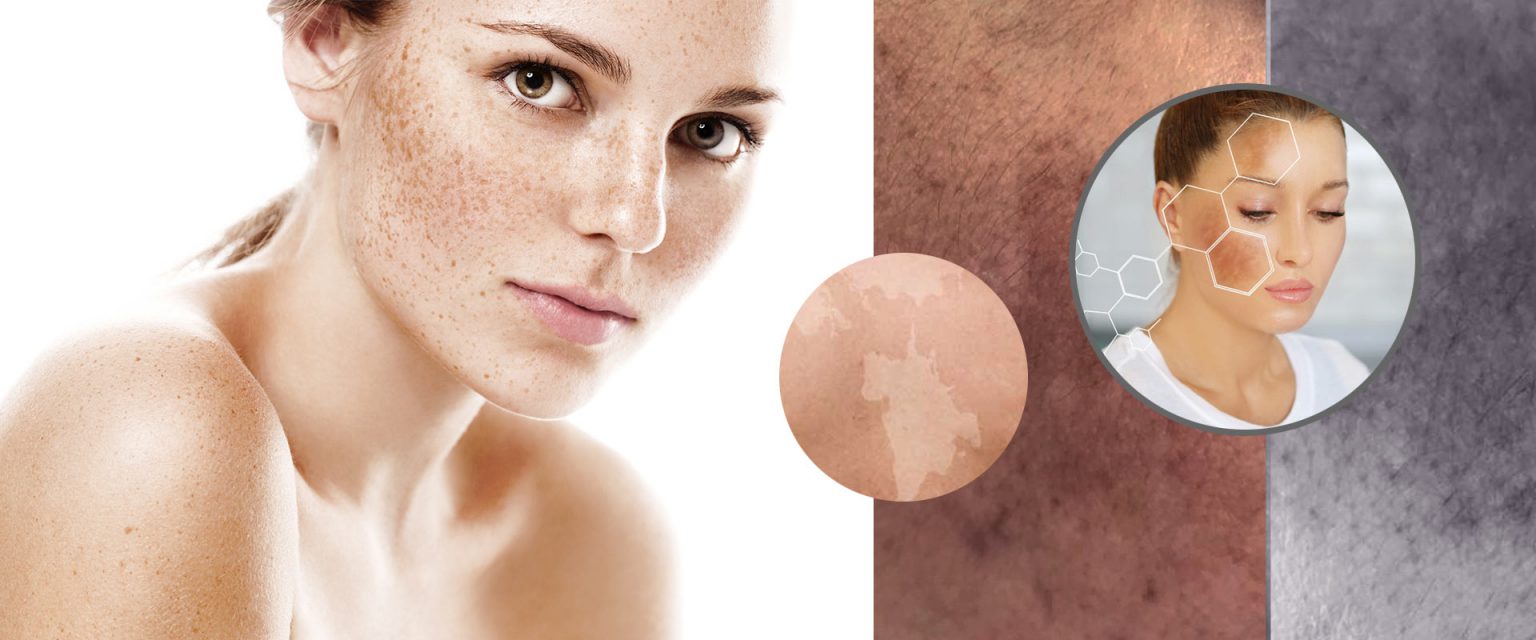 Vad är pigmentfläckar och melasma? | Skin Center | Hudvård | Skönhet ...
